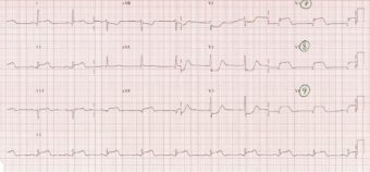 Posterior Myocardial Infarction • LITFL • ECG Library Diagnosis