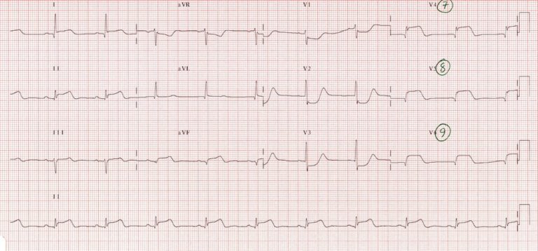 Posterior Myocardial Infarction • LITFL • ECG Library Diagnosis