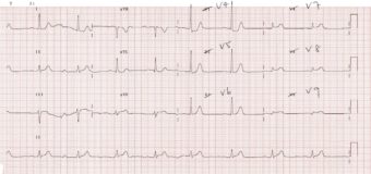 Posterior Myocardial Infarction • LITFL • ECG Library Diagnosis