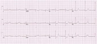 Posterior Myocardial Infarction • LITFL • ECG Library Diagnosis