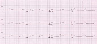 Posterior Myocardial Infarction • LITFL • ECG Library Diagnosis