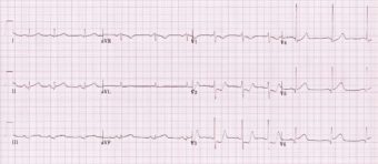 Posterior Myocardial Infarction • LITFL • ECG Library Diagnosis