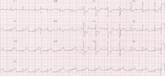 Posterior Myocardial Infarction • LITFL • ECG Library Diagnosis