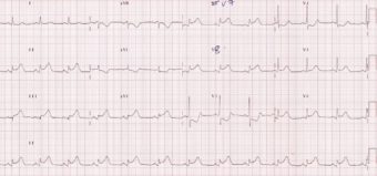 Posterior Myocardial Infarction • LITFL • ECG Library Diagnosis