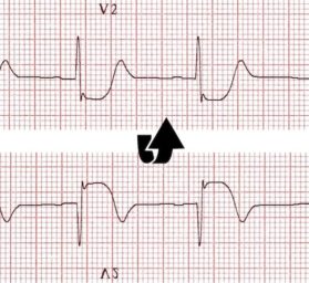 Posterior Myocardial Infarction • LITFL • ECG Library Diagnosis