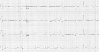 Premature Ventricular Complex (PVC) • LITFL • ECG Library Diagnosis