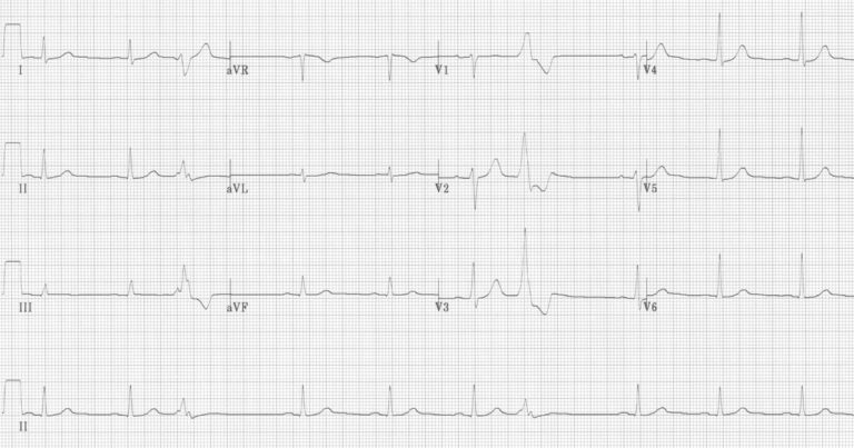 Premature Ventricular Complex (PVC) • LITFL • ECG Library Diagnosis