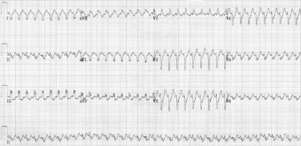 Idiopathic Fascicular Left Ventricular Tachycardia • LITFL • ECG Library