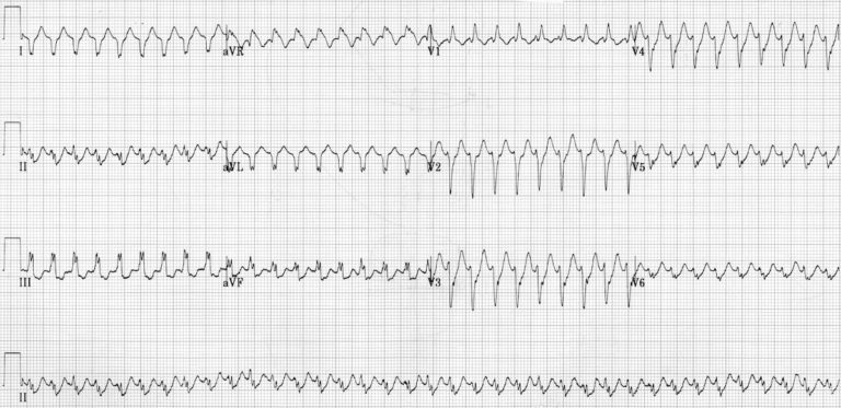 Idiopathic Fascicular Left Ventricular Tachycardia • LITFL • ECG Library