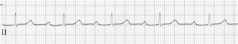 PR Interval • LITFL • ECG Library Basics
