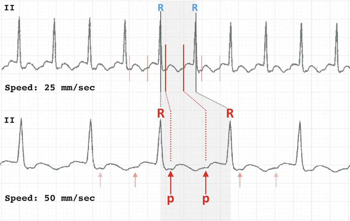 ECG Rate Interpretation LITFL Medical Blog ECG Library Basics ECG Rate Interpretation LITFL Medical Blog ECG Library Basics