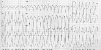 Right Ventricular Outflow Tract (RVOT) Tachycardia • LITFL • ECG Library
