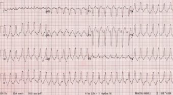 Right Ventricular Outflow Tract (RVOT) Tachycardia • LITFL • ECG Library