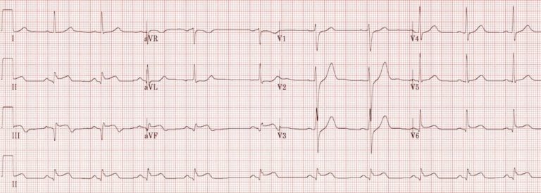 Inferior STEMI • LITFL • ECG Library Diagnosis