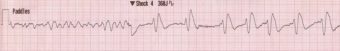 The ST Segment • LITFL • ECG Library Basics