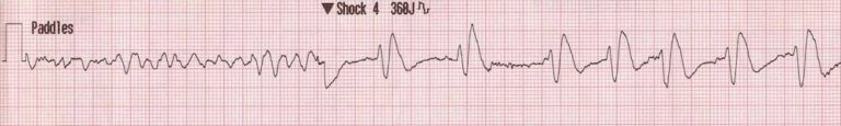 The ST Segment • LITFL • ECG Library Basics