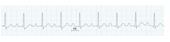 First Degree Heart Block • LITFL • ECG Library Diagnosis