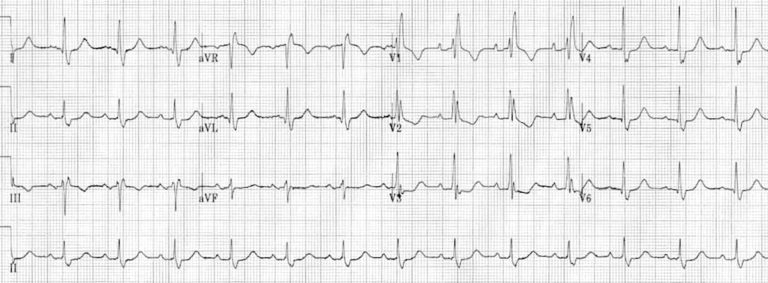 Right Bundle Branch Block (RBBB) • LITFL • ECG Library Diagnosis