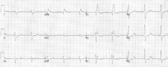 Right Bundle Branch Block (RBBB) • LITFL • ECG Library Diagnosis
