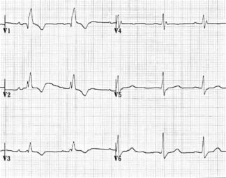 Right Bundle Branch Block (RBBB) • LITFL • ECG Library Diagnosis