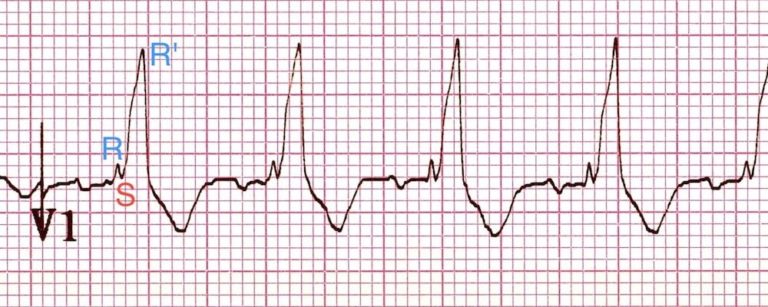 Right Bundle Branch Block (RBBB) • LITFL • ECG Library Diagnosis