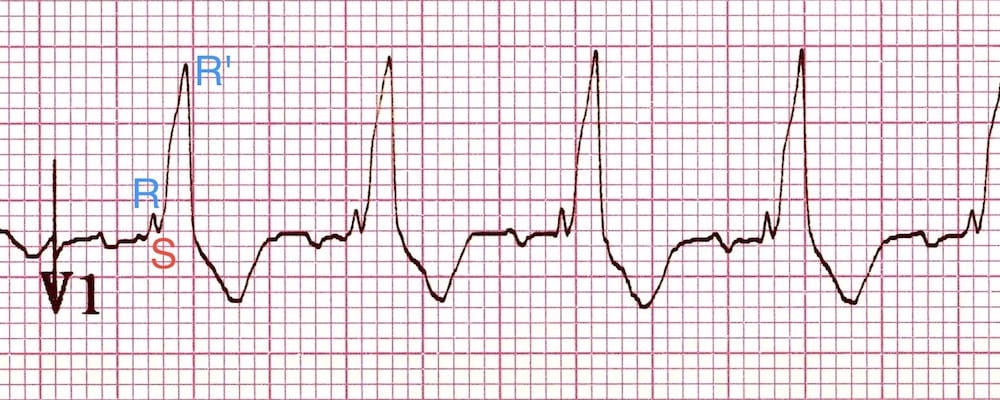 Right Bundle Branch Block RBBB LITFL ECG Library Diagnosis Right Bundle Branch Block RBBB LITFL ECG Library Diagnosis