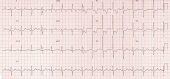 The ST Segment • LITFL • ECG Library Basics