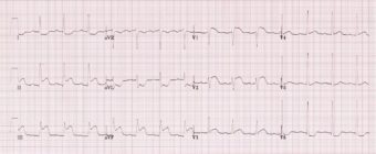 Right Ventricular Infarction • LITFL • ECG Library Diagnosis