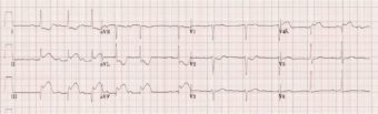 Right Ventricular Infarction • LITFL • ECG Library Diagnosis