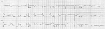 Right Ventricular Infarction • LITFL • ECG Library Diagnosis