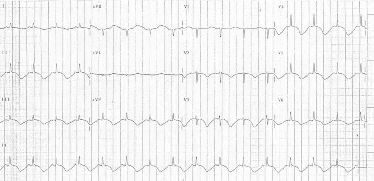 Raised Intracranial Pressure ECG Changes • LITFL • ECG Library Raised Intracranial Pressure ECG Changes • LITFL • ECG Library