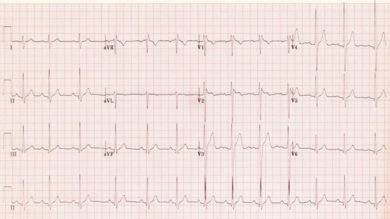 Super Axis Man SAM • LITFL • ECG Library Basics