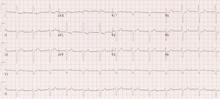 Super Axis Man SAM • LITFL • ECG Library Basics