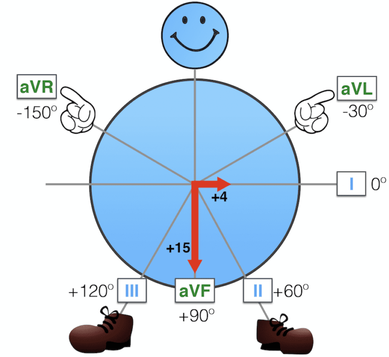 Super Axis Man SAM • LITFL • ECG Library Basics