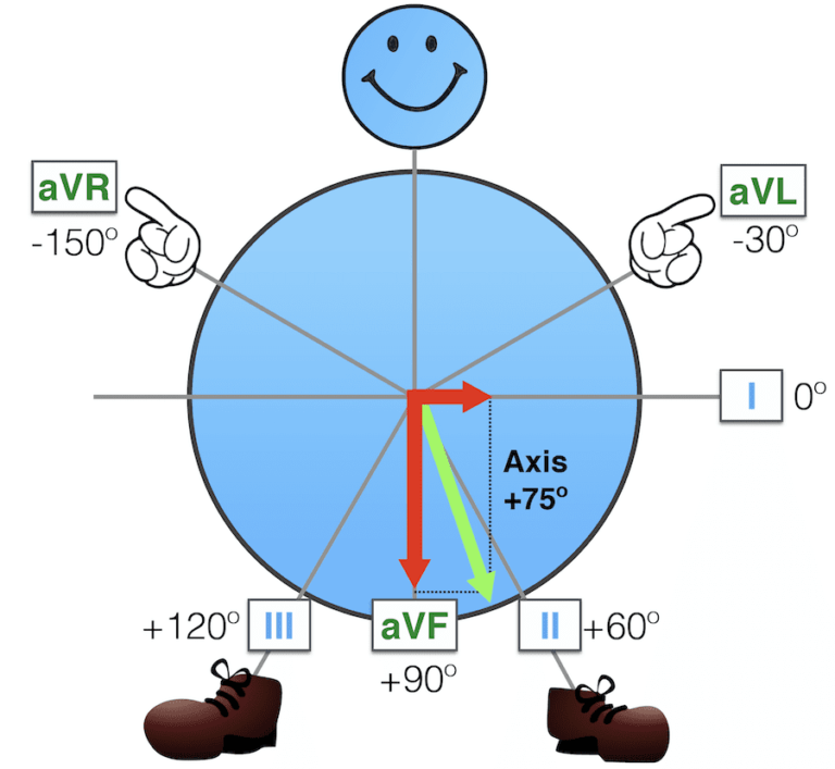 Super Axis Man SAM • LITFL • ECG Library Basics