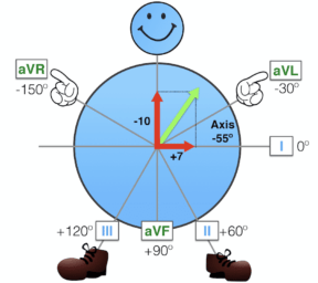 Super Axis Man SAM • LITFL • ECG Library Basics