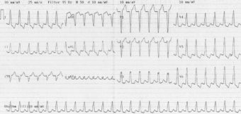 VT versus SVT • LITFL Medical Blog • ECG Library Basics