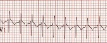 Common paediatric arrhythmias • LITFL • ECG Library Diagnosis