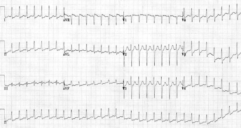 ST Elevation in aVR • LITFL • ECG Library Diagnosis