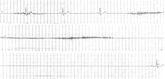 Sinus Node Dysfunction (Sick Sinus Syndrome) • LITFL • ECG Library