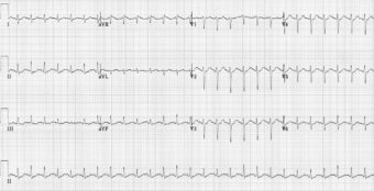 Sinus tachycardia • LITFL • ECG Library Diagnosis