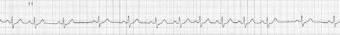 Sinus Arrhythmia • LITFL Medical Blog • ECG Library Basics