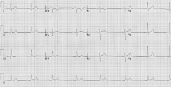 Beta-blocker and Calcium-channel blocker toxicity • LITFL • ECG Library