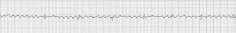 Atrial Flutter • LITFL • ECG Library Diagnosis