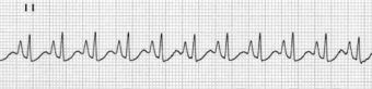 P wave • LITFL • ECG Library Basics