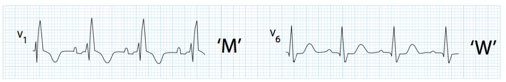Right Bundle Branch Block (RBBB) • LITFL • ECG Library Diagnosis