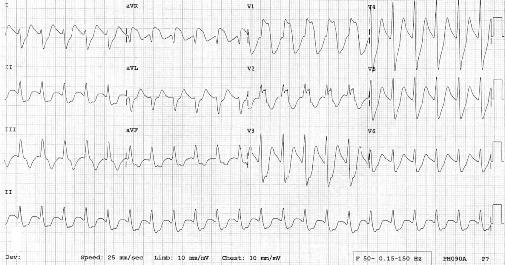 VT versus SVT • LITFL Medical Blog • ECG Library Basics