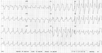 VT versus SVT • LITFL Medical Blog • ECG Library Basics