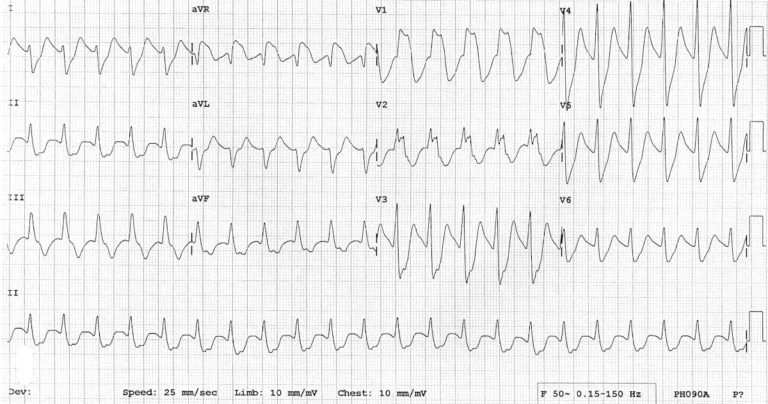 VT versus SVT • LITFL Medical Blog • ECG Library Basics