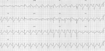 Tricyclic Overdose • LITFL • ECG Library
